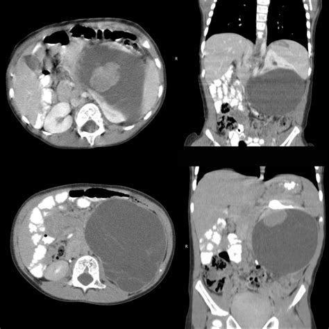 Wilms Tumor Nephroblastom Tumoren Im Kindesalter Nephroblastom Zqrnl