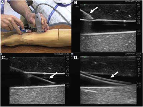 Better With Ultrasound Chest