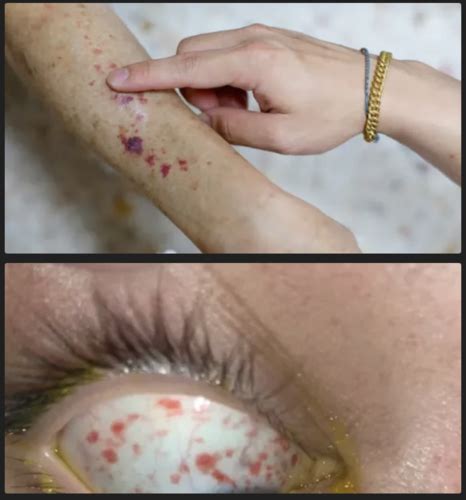 Infective Endocarditis Flashcards Quizlet