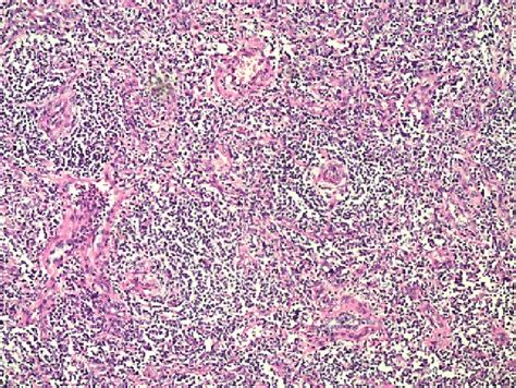 Histopathology Increased High Endothelial Venules Download