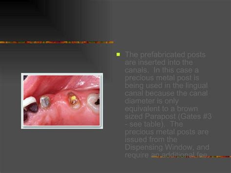 Post And Core PPT Oral Care Personal Care