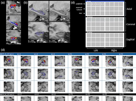 exemplary overlays of full segmentation results combined hippocampal