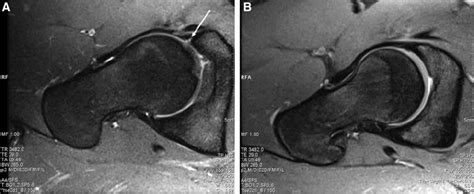 Acetabular Labral Tear A Compared With Normal Hip Anatomy B A