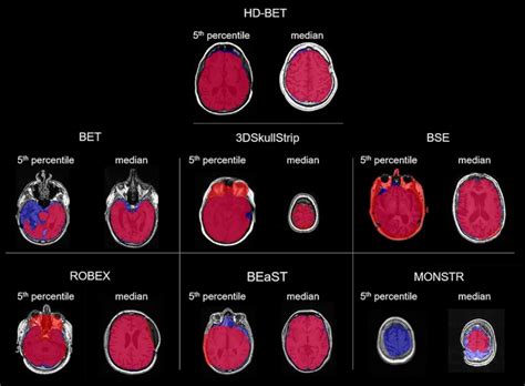Automated Brain Extraction Of Multisequence MRI Using Artificial Neural Networks PMC
