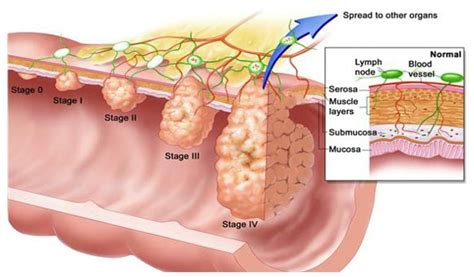 Bowel Cancer Staging