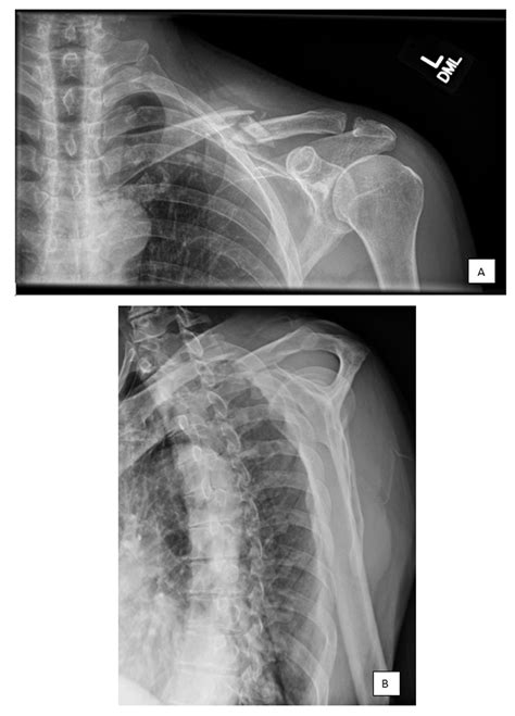 Midshaft Clavicular Fracture Management At John Ogburn Blog