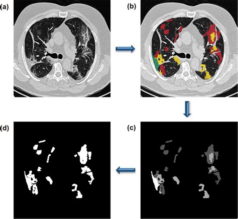 example of deriving binary lesion mask from radiologist annotations on