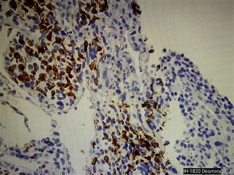 Immunohistochemistry Slide Showing Strong Cytoplasmatic And Focal