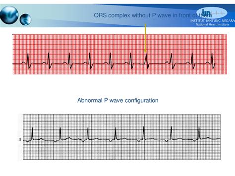 Cvt Mohd Farid Basic Ecg Part Iii P Wave And Pr Interval