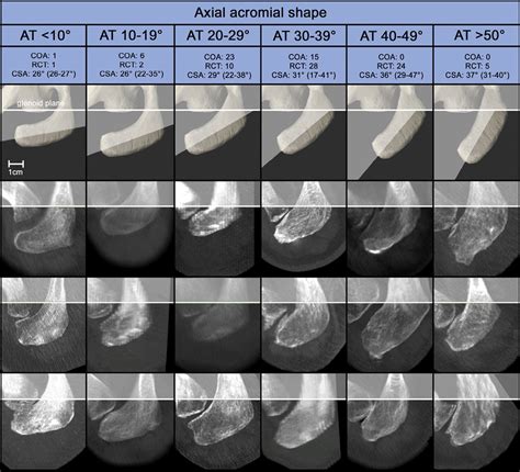 Illustrated Lateral Acromial Shape From The Axial View And Distribution Download Scientific