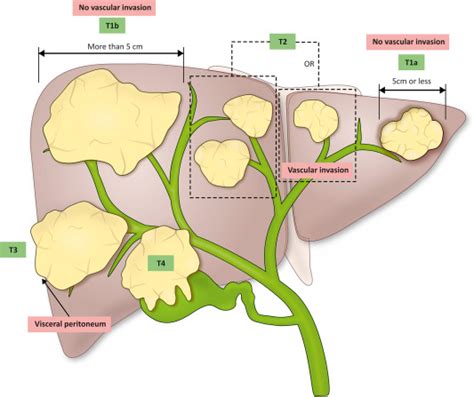 The Morphomolecular Features Of Cholangiocarcinoma In The Personalised Era Diagnostic