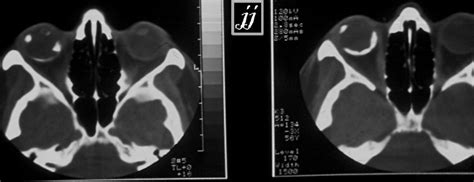 Brain Scleral Calcification And Blindness 2 Radioogle