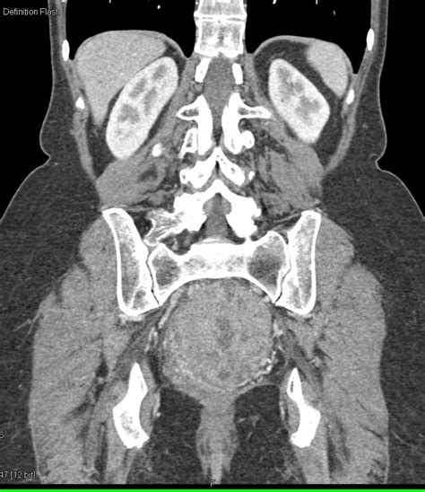 Rectal Gist Tumor Colon Radiology Case Studies Ctisus Ct Scanning