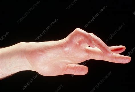 Claw Finger Deformity