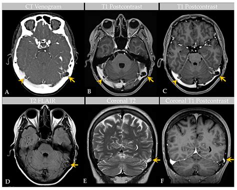 Giant Arachnoid Granulations Diagnostic Workup And Characterization In