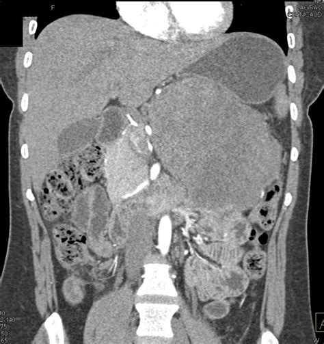Gastric Gist Tumor Stomach Case Studies Ctisus Ct Scanning