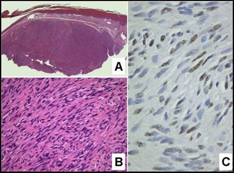 Nodular Kaposi Sarcoma A The Dermis Is Expanded By A Solid Tumor Download Scientific Diagram