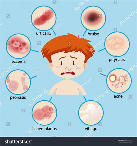 Diagram Showing Babe Different Skin Conditions Stock Vector Royalty Free 1539936185
