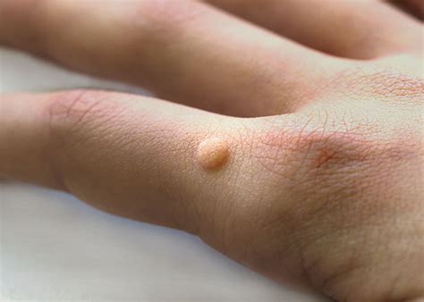 Verruca Plana Removal