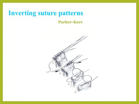 Basic Suture Patterns Ppt