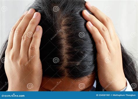 A Woman Has Problems With Hair And Scalp Stock Image Image Of Health Discomfort 234581981
