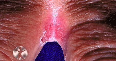 Hand Dermatitis Image