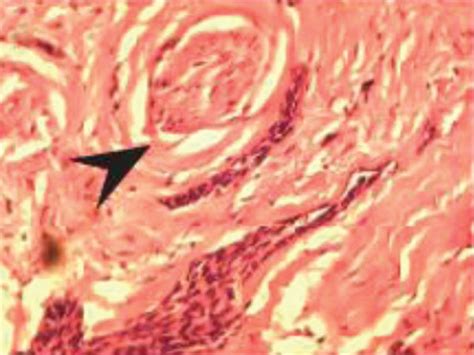 A Photomicrograph Of Orbit With Well Differentiated Squamous Cell