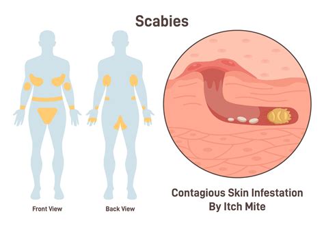 Scabies Clinical Signs And Symptoms Nursing Ce Central