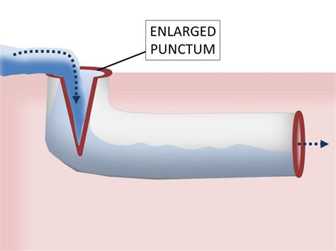 Punctoplasty Jonathan Norris