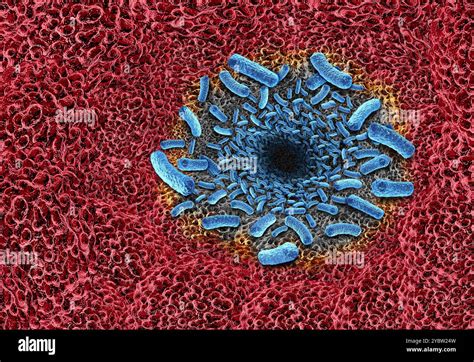 Flesh Eating Disease And Life Threatening Bacteria As Flesh Eating