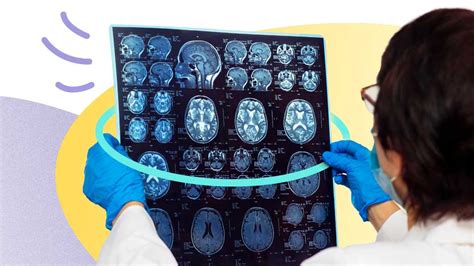 How Does Multiple Sclerosis Affect The Body Ausmed