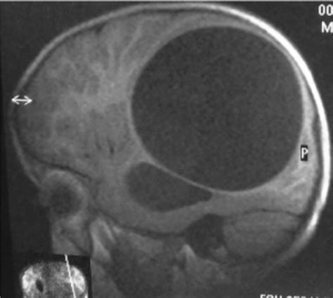 Cat Scan Of Cerebral Echinococcosis Although Cns Involvement Of