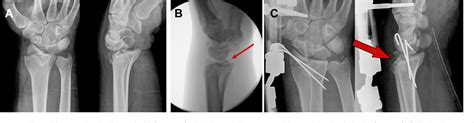 Figure 1 From Uncommon Dorsal Radiocarpal Fracture Dislocation Complicated With Median Nerve