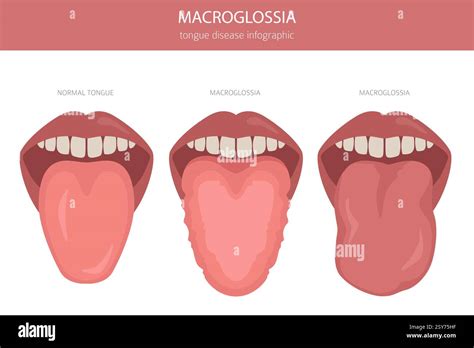 Macroglossia Tongue Disease Oral Medicine Medical Infographic Design