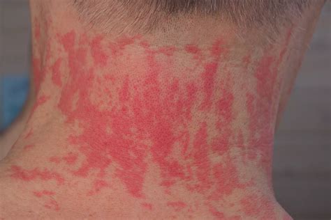 Neck Rash Causes And How To Treat And Prevent It