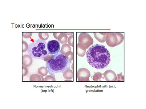 Toxic Granulation Vs Basophil