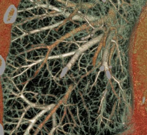 Photon Counting L Philips Healthcare