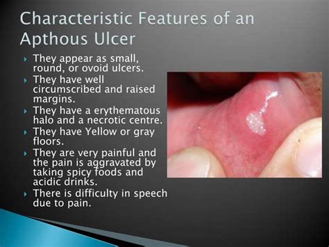 Management And Treatment Of Recurrent Apthous Ulcers Ppt