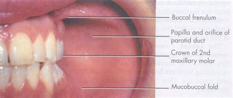 Mucobuccal Fold