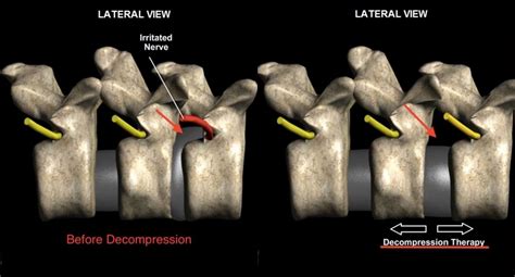 Spine Institute Non Surgical Spinal Decompression Centre