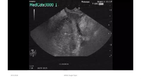 Hepatobiliary Eus Apasl Pptx