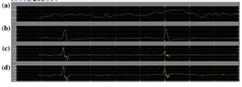 A Pure Eeg Signal B Eeg Ecg C Error Signal D De Noised Eeg Signal