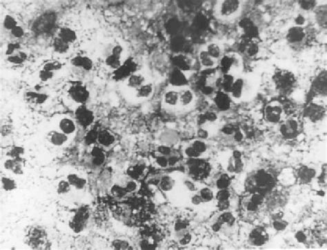 Suppurative Lymphadenitis Numerous Neutrophils With A Necrotic Download Scientific Diagram