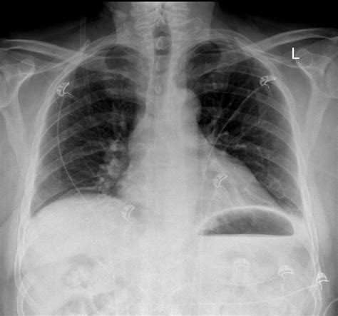 Pulmonary Embolism Chest X Ray