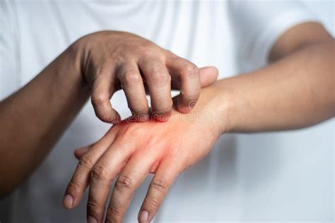 Man Scratching His Hand Medical Stock Image Image Of Atopic Care 266981329