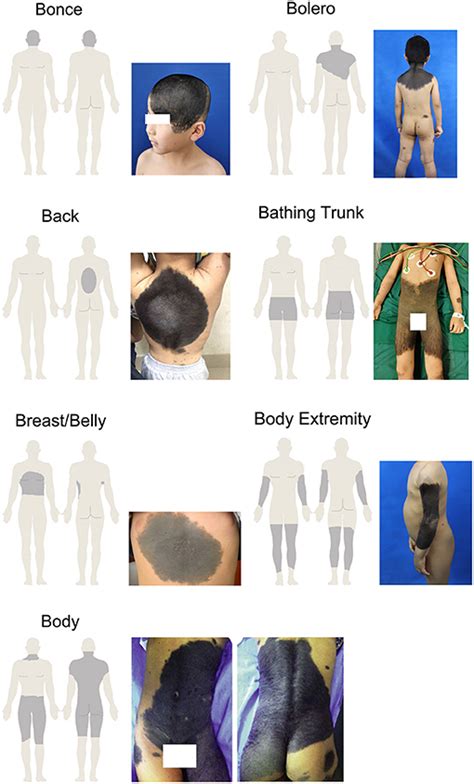 Congenital Melanocytic Nevus Compound Type