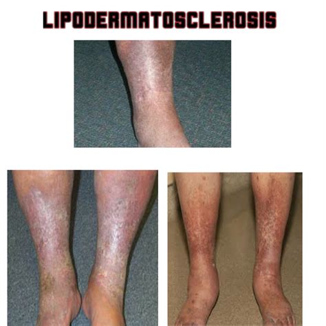 Lipodermatosclerosis Medizzy