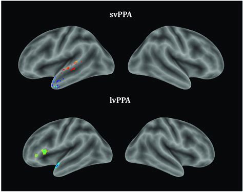 Gray Matter Regions Associated With Object And Action Naming