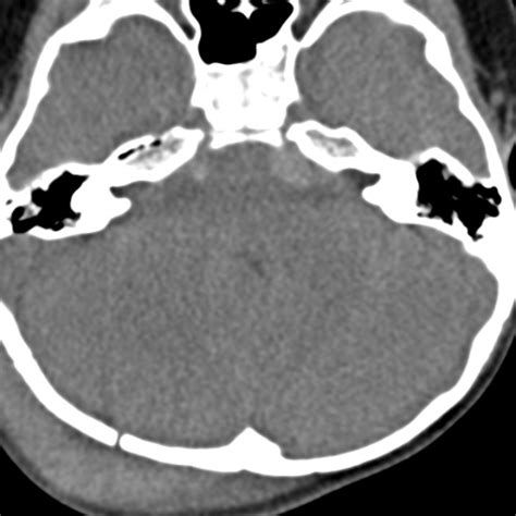 Normal Ct Cervical Spine Pediatric Radiopaedia 52549 58462 Axial Non Contrast Nc Commons