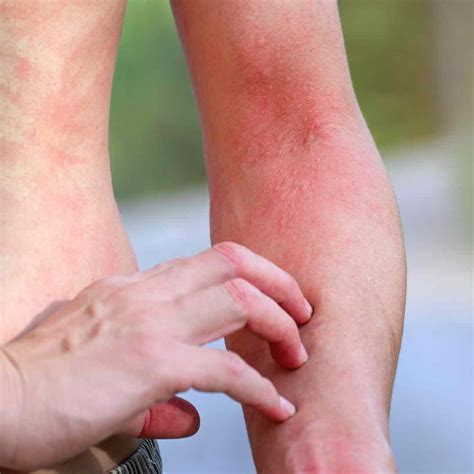 Lead Poisoning And Health Understanding The Risks And Preventive Measures